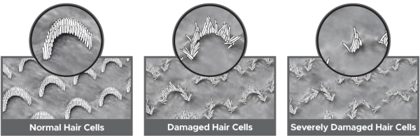 Presbycusis and it's effects on speech understanding - Davidson Hearing ...